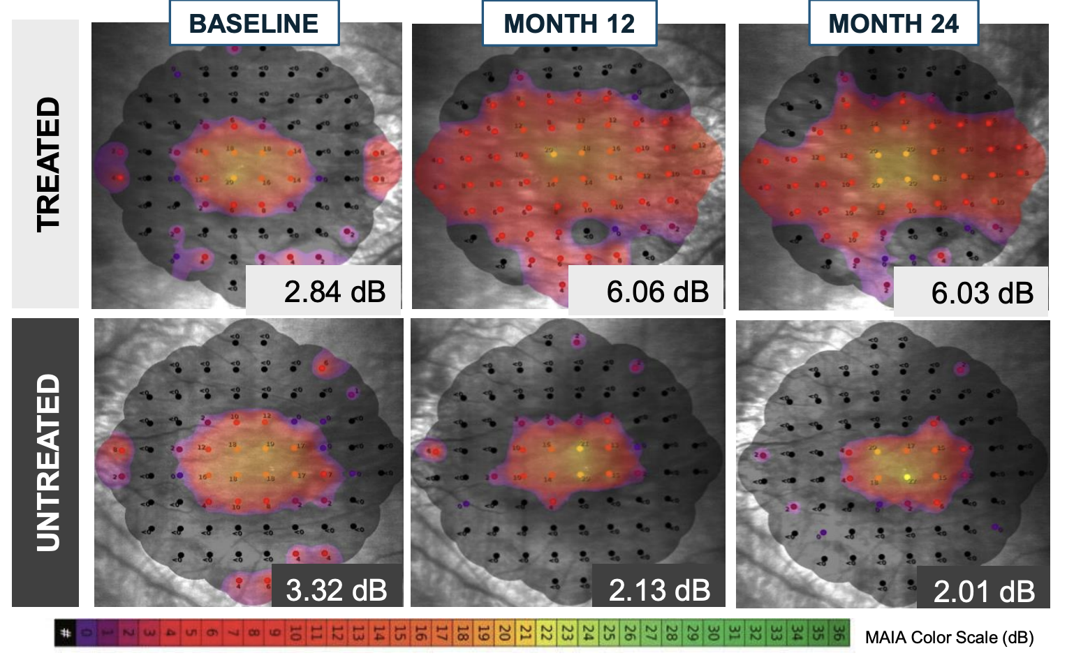 Subretinal Gene Therapy Drug laru-zova (AGTC-501) for X-Linked ...